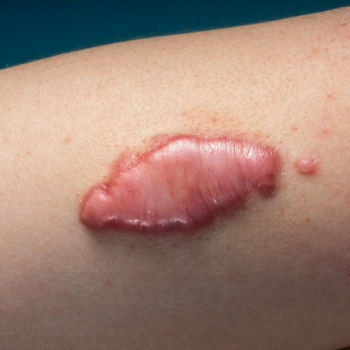 Hypertrofische littekens en keloïd | DermaTeam Cosmetic